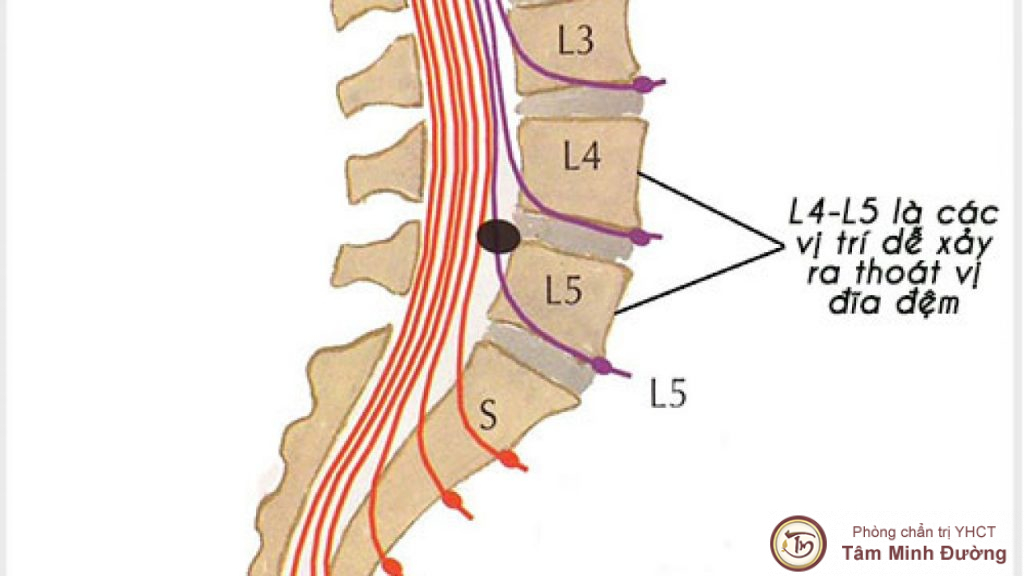 Thoát vị đĩa đệm l4 l5, l5 s1 là gì? Triệu chứng và điều trị bệnh hiệu quả - Tâm Minh Đường